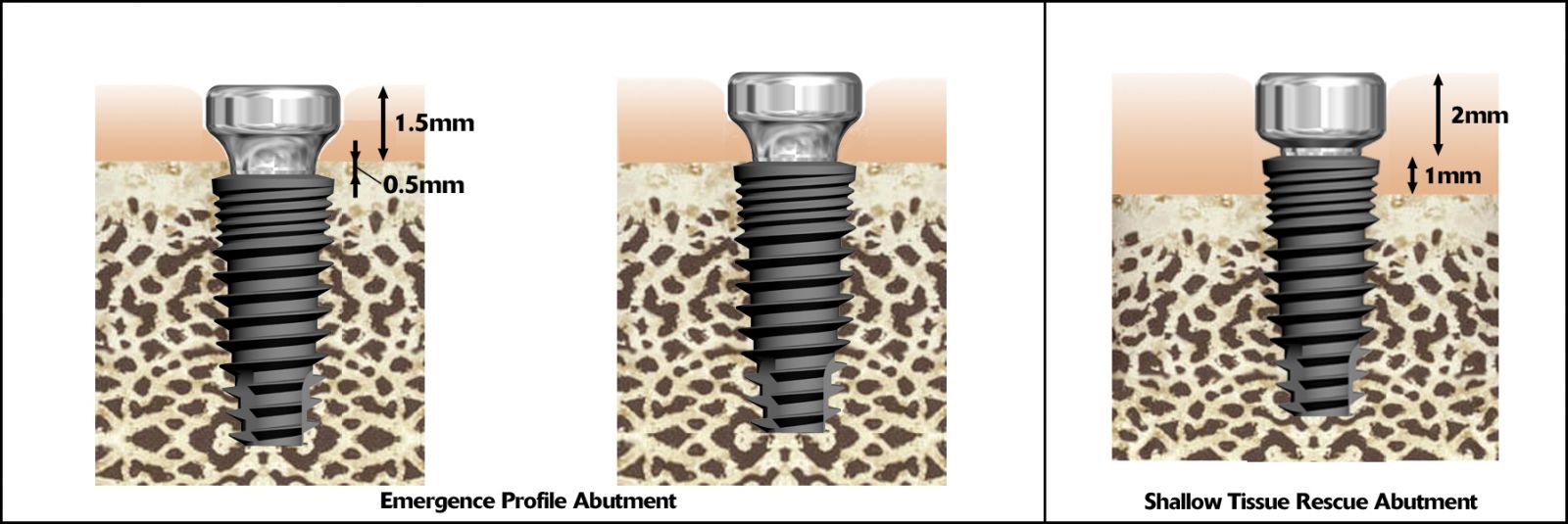 Healing Abutments Shop Online Blue Sky Bio Compatibility